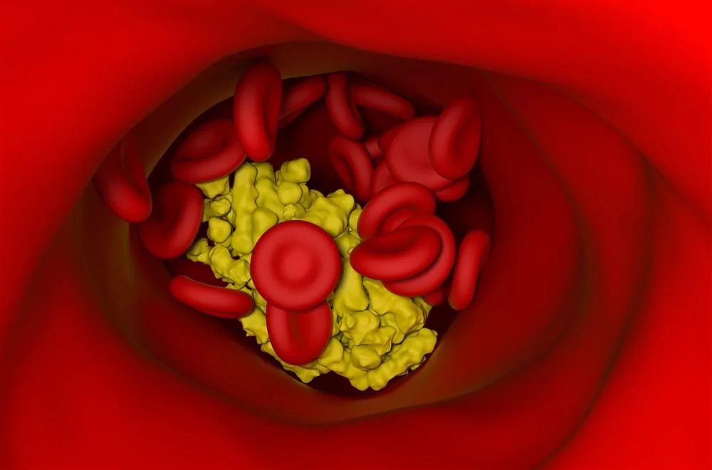 Hipercolesterolemie (colesterol mare): cauze, simptome, tratament | Dr ...